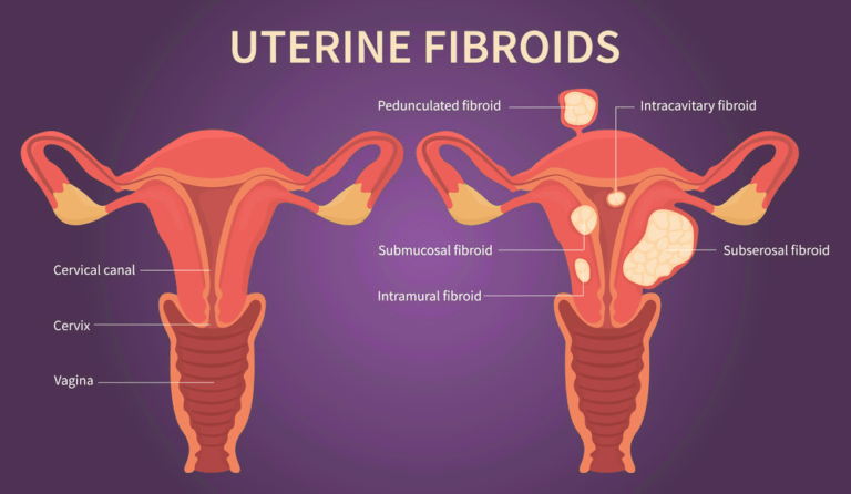 Uterine Fibroids and Pregnancy: Risks and Considerations - meerut ivf ...